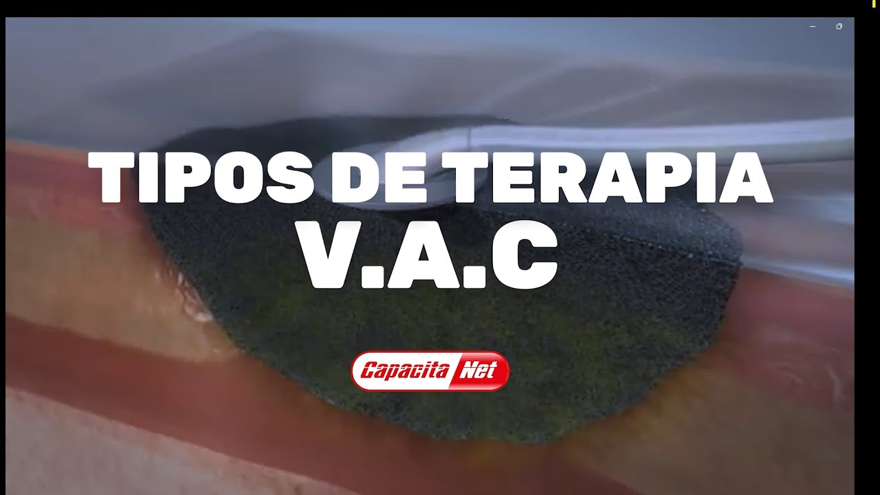 Tipos de terapia VAC by Capacitanet - YouTube