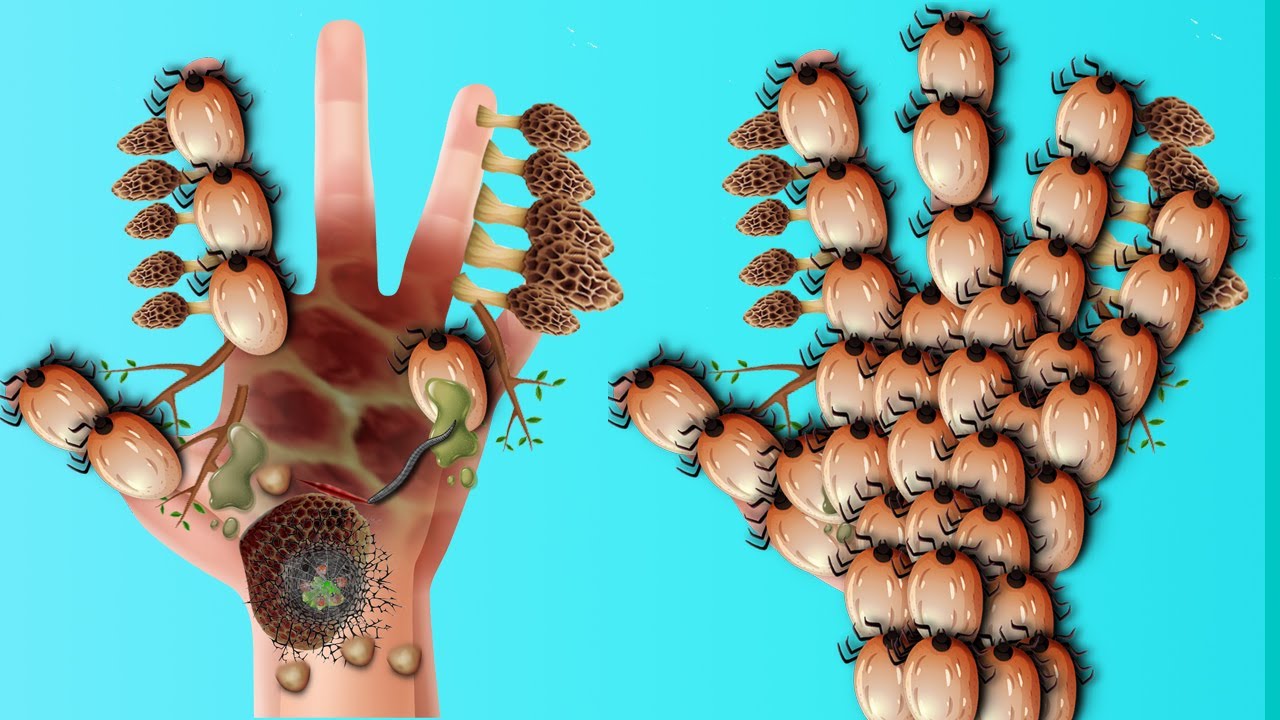 ASMR Remove Worm & Dog Ticks MAggots Infected Hand | Severely injured ...