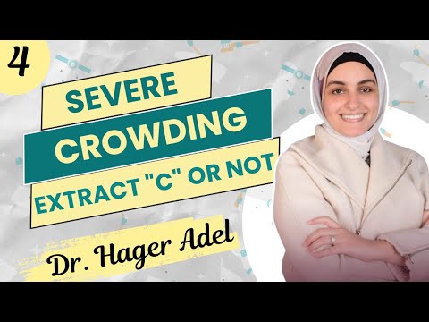 Crowding in incisors _ extract C ? _ || Dr. Hager Adel - YouTube