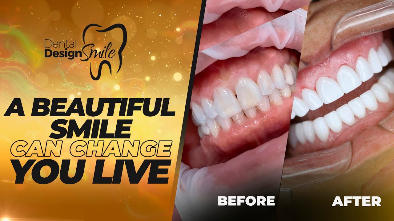Porcelain design: Elevate your smile with exquisite craftsmanship - YouTube