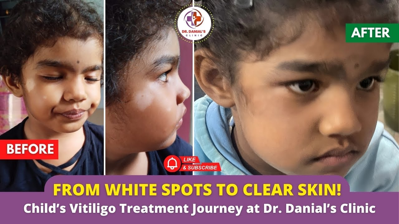 Shocking Vitiligo Recovery in a Kid! | Before & After Results at Dr ...
