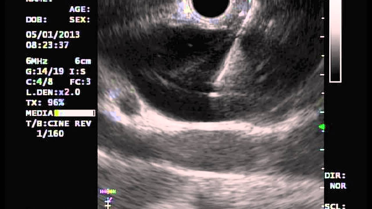 EUS-Guided Biliary Drainage - YouTube