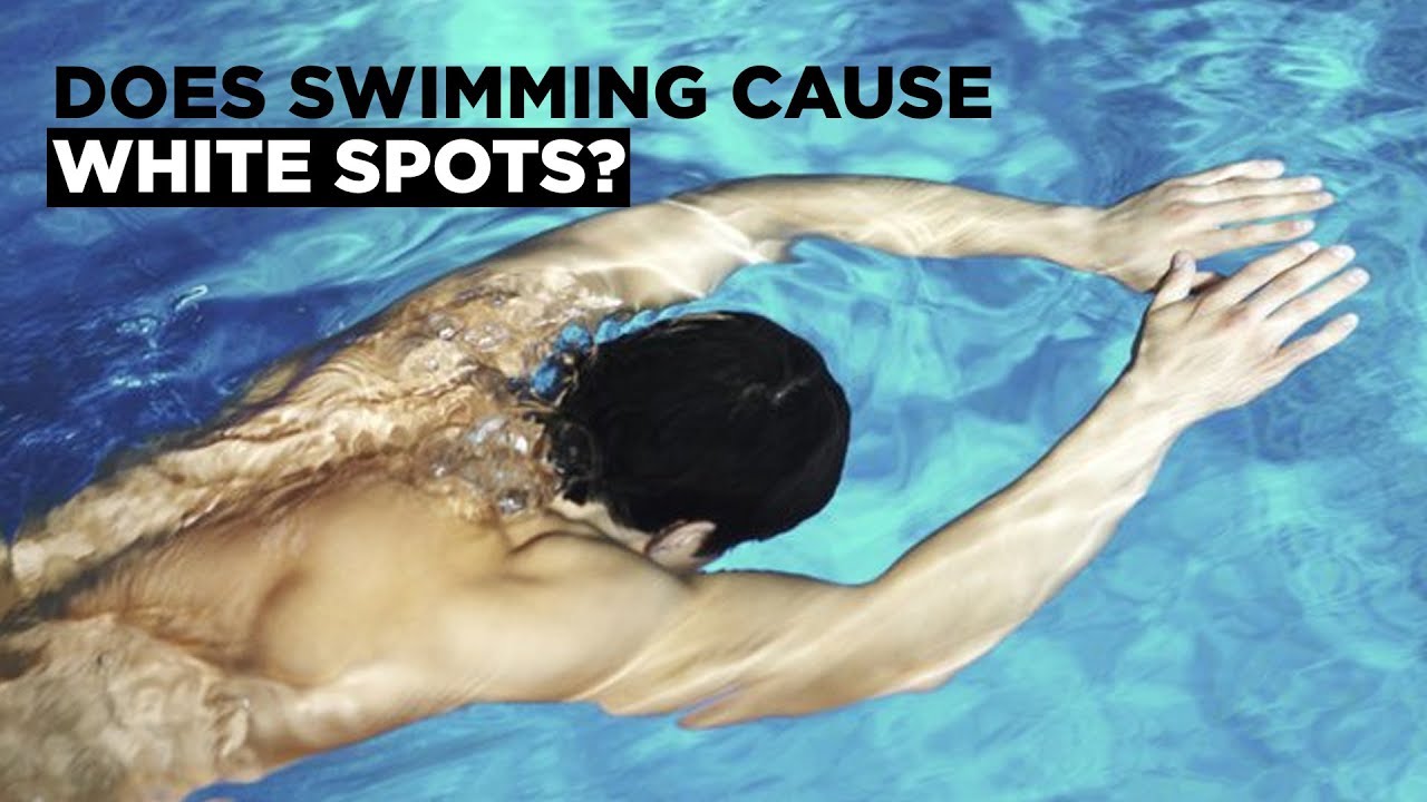Does Swimming Cause White Spots? || Aimil Healthcare || Dr. Nitika ...
