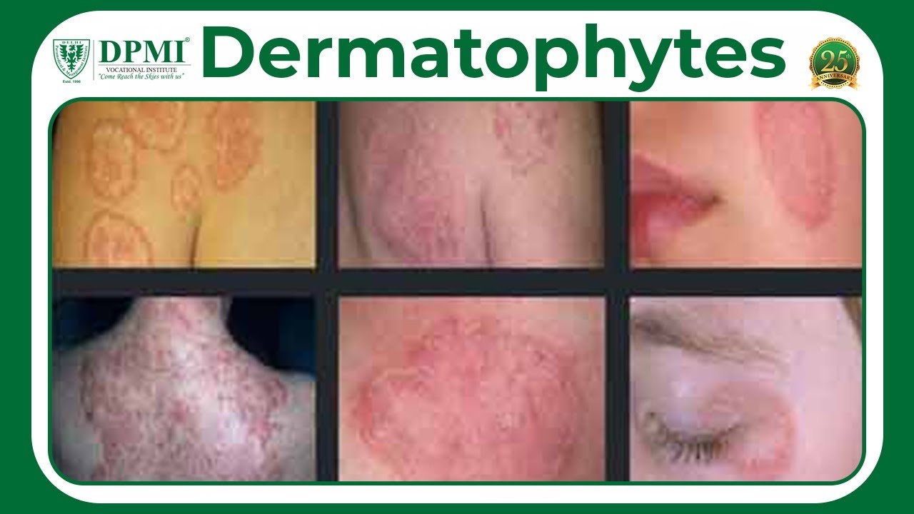 Dermatophyte Infection: Types Of Dermatophytes? Dermatophyte: Symptoms ...