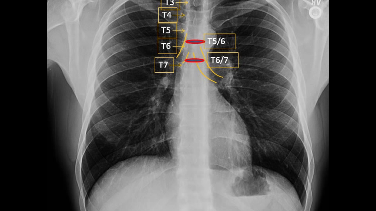 Endotracheal Tube Placement X Ray