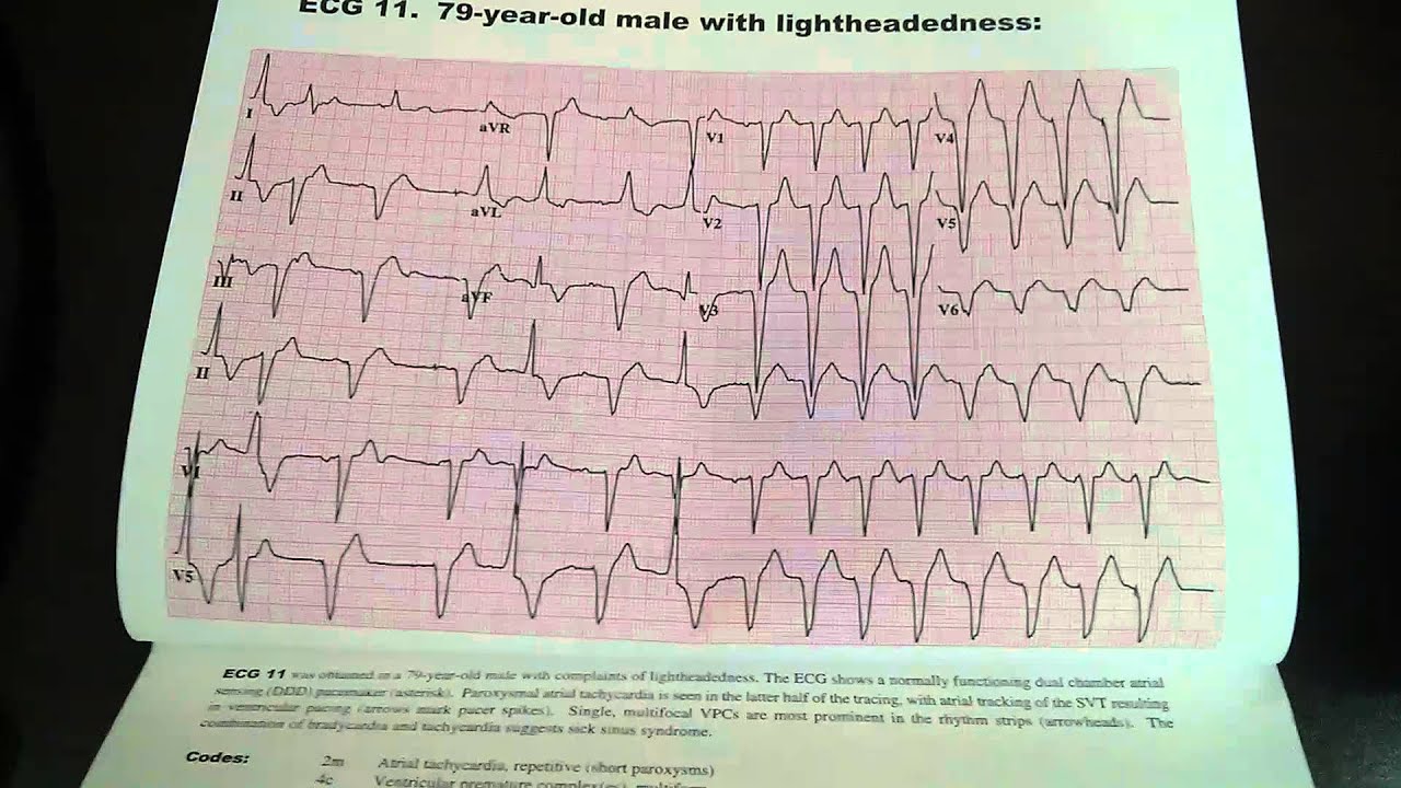 EKG Abnormal ECG Cardiology Electrocardiogram Www drbenzur YouTube