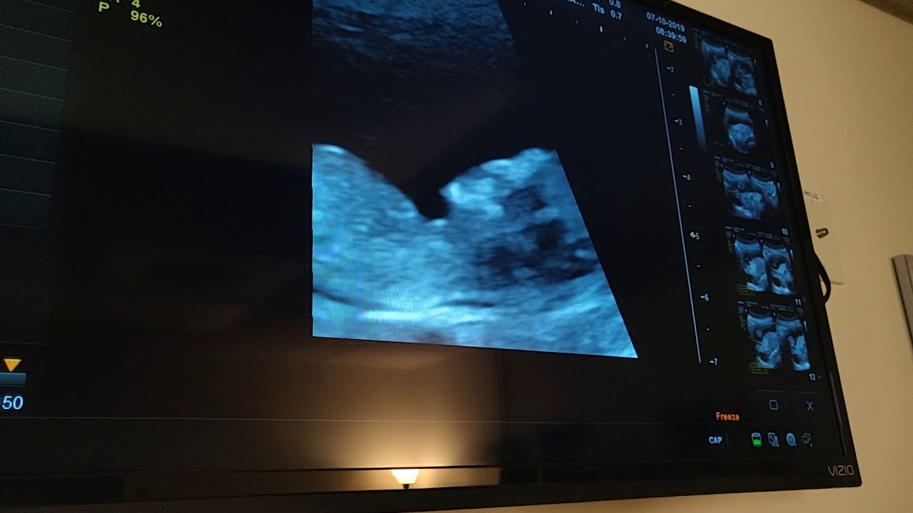 What its like to see a babys first sonigram / ultrasound !!!!! - YouTube