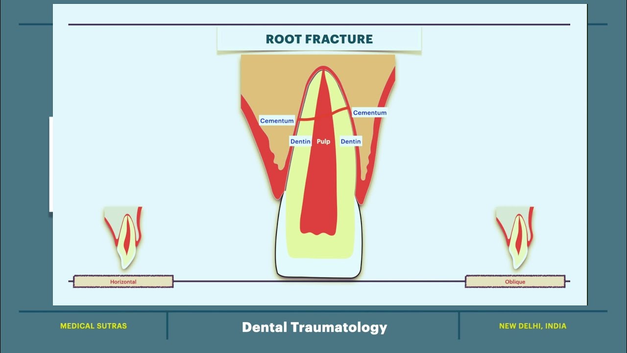 How to manage tooth root fracture ?? Root Fracture - YouTube
