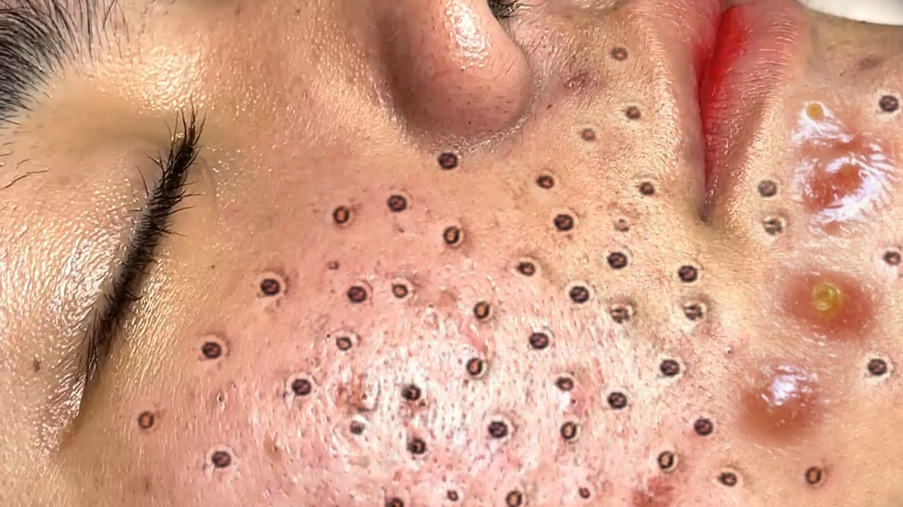 Blackhead Removal With Sac Dep Spa @100074740 - YouTube