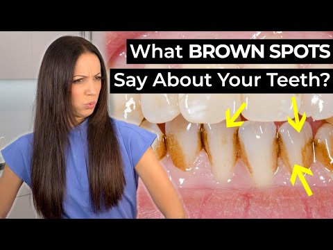 Can Dentist Remove Brown Stains Between Teeth