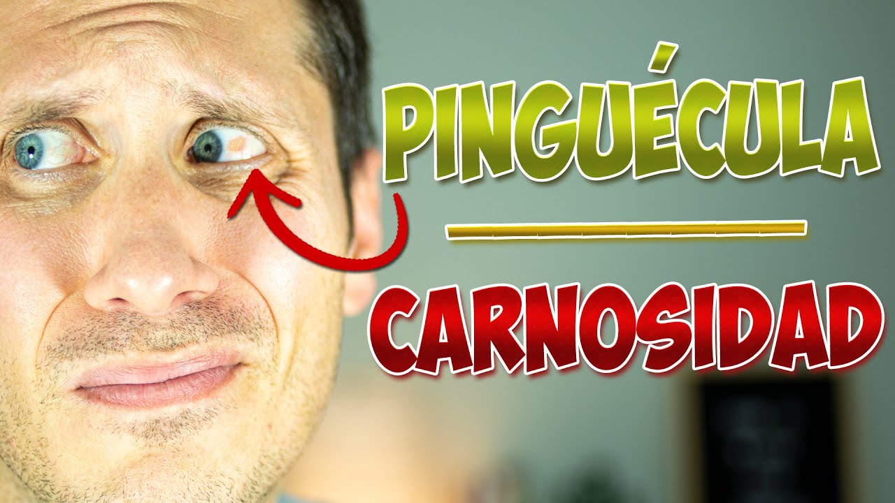 Influencia trapo Bien educado pinguecula en el ojo Médula Pacífico Persona