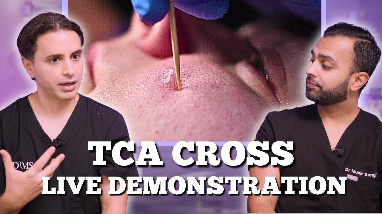TCA Cross For Acne Live Demonstration | TCA Cross Aftercare Advice | Dr ...