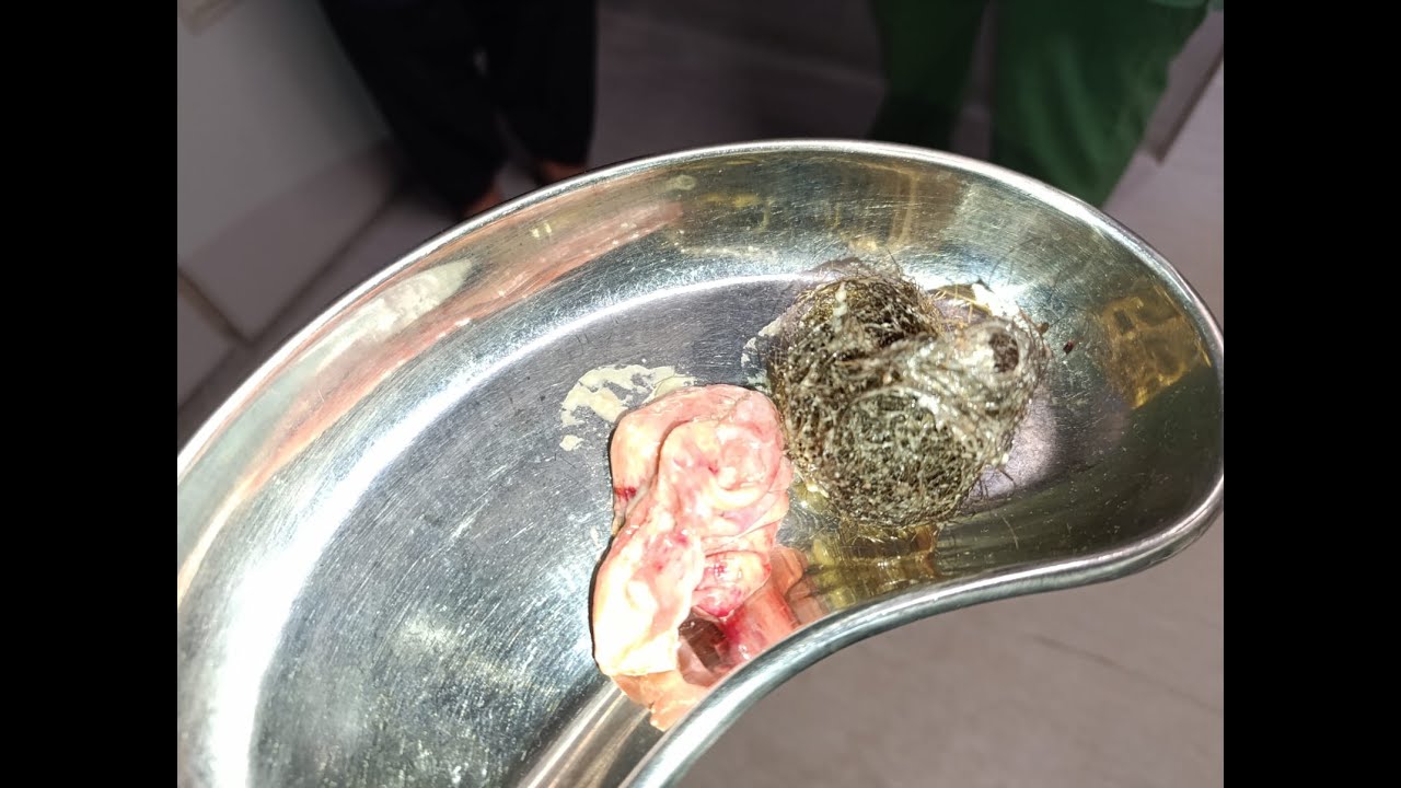 Laparoscopic Excision of dermoid cyst-Step by Step - YouTube