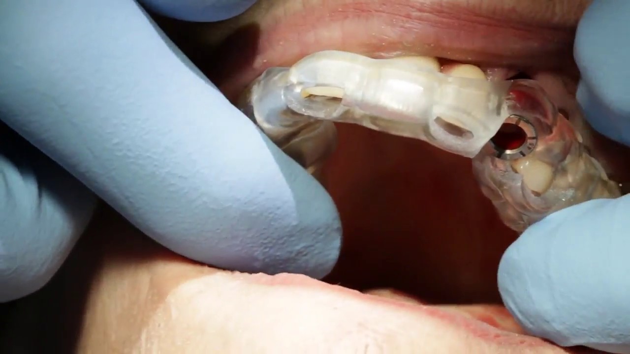 Precision Guided Surgery with Argon K3Pro implant - YouTube