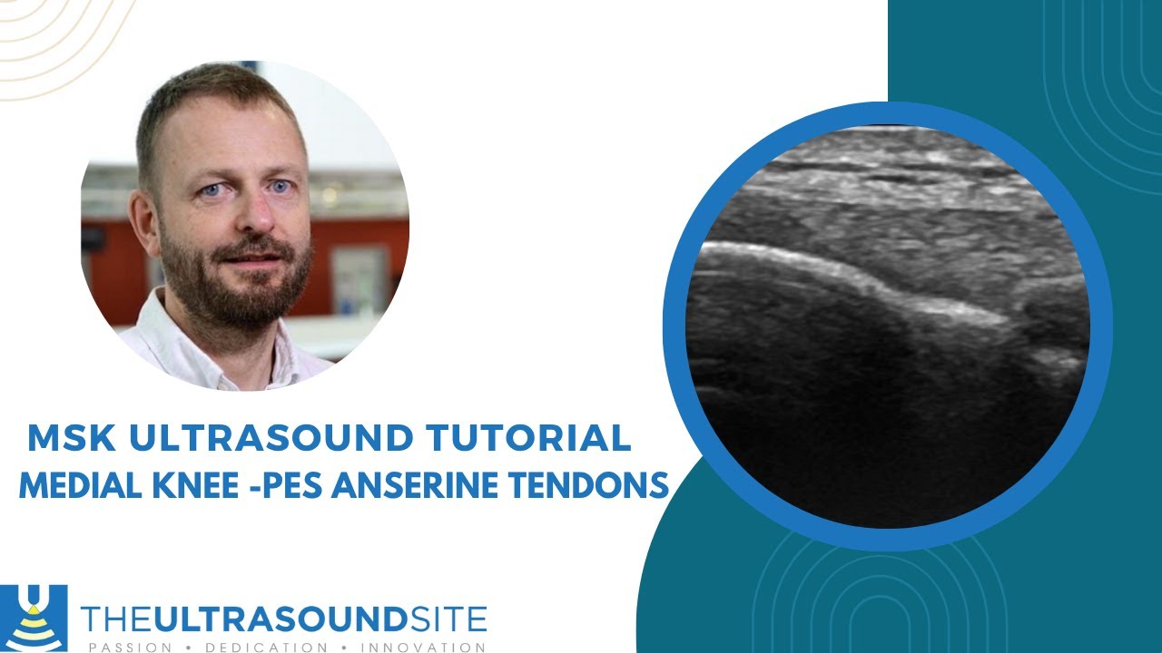 How to find the Pes Anserine tendons on ultrasound - YouTube