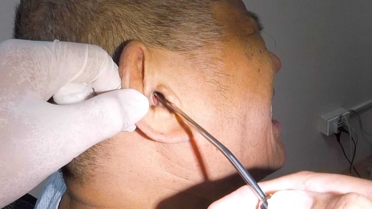 This is How to Remove Man's Rock Hard Earwax - YouTube
