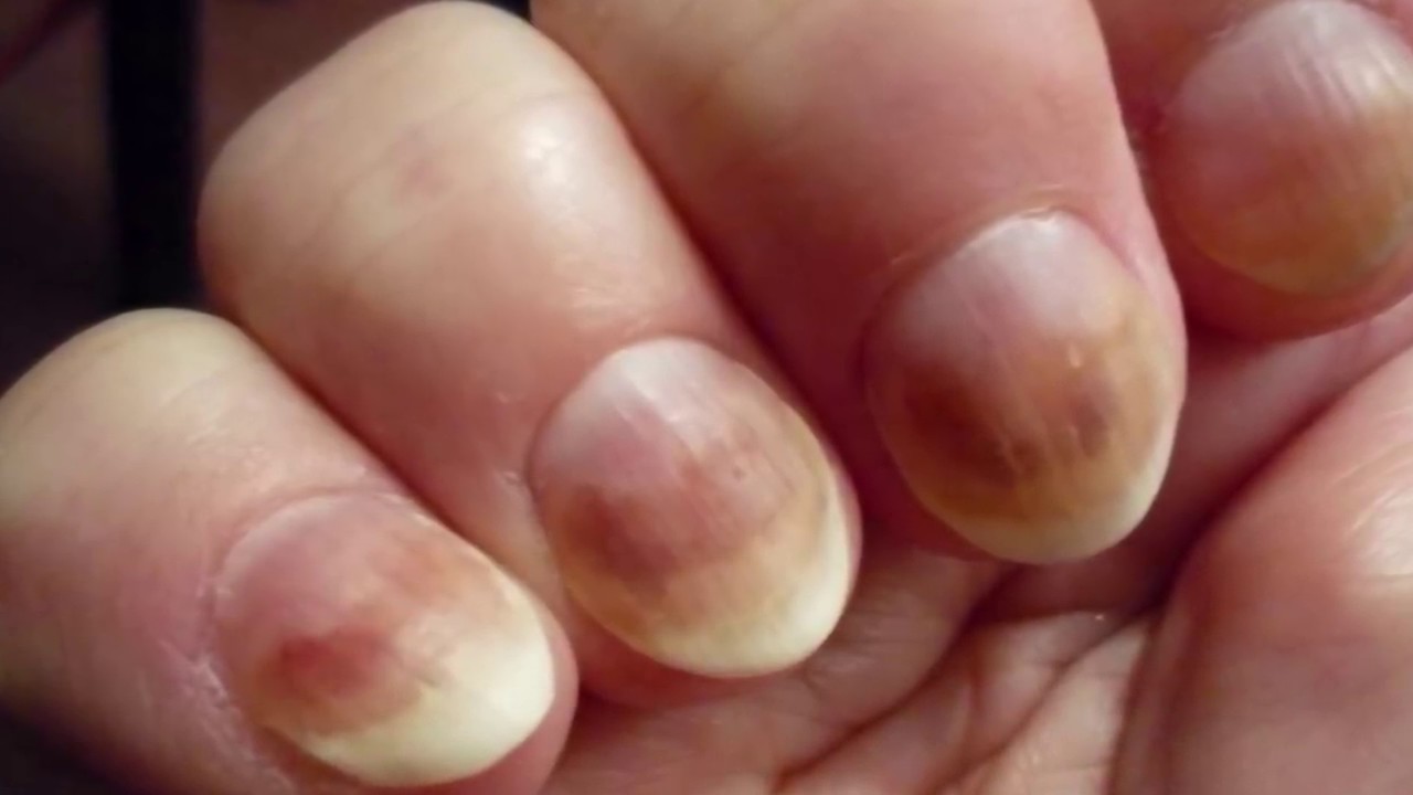 Solar Comedones vs Senile Comedones - #1 Blackhead Mask! - YouTube