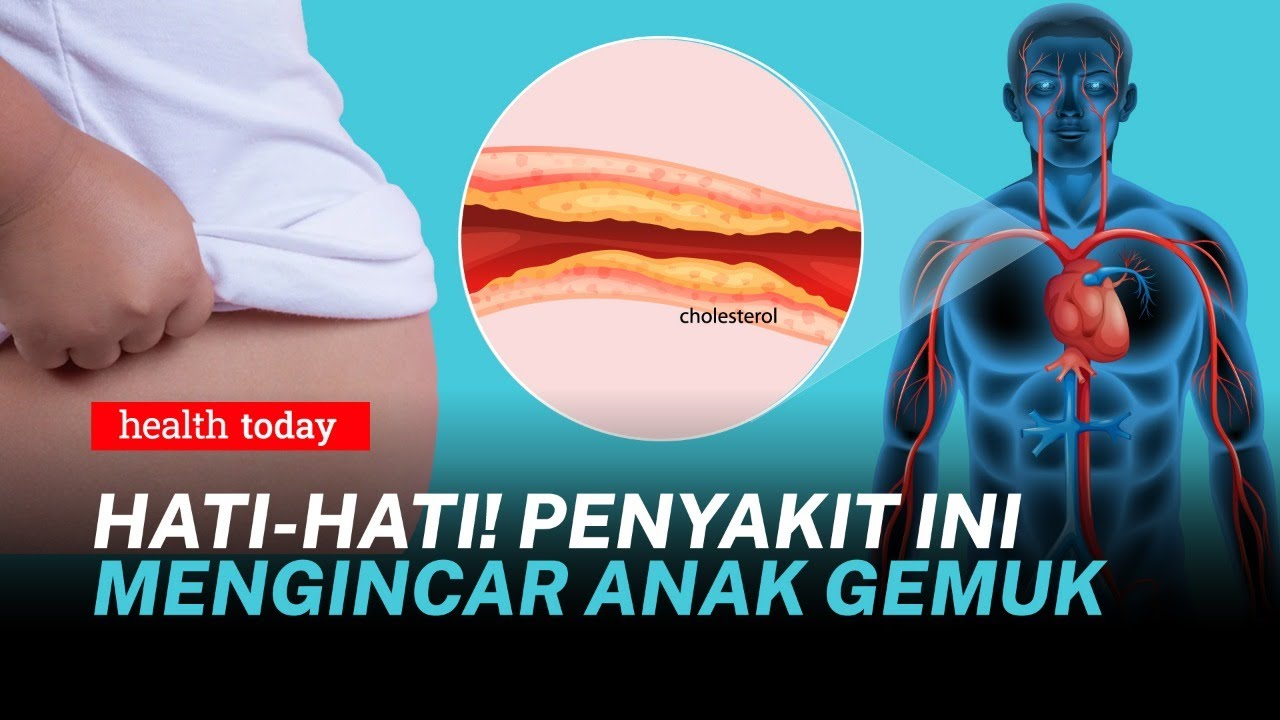 Bahaya Obesitas atau Kegemukan pada Anak, Ini TIPS Mengurangi Berat ...