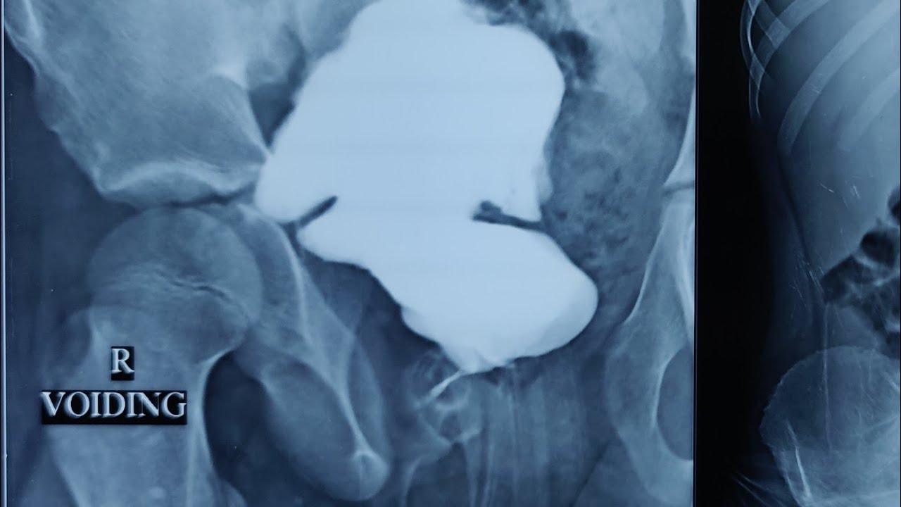 Cystoscopy cauterization of fistulous tract between exstrophy augment ...