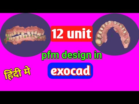 pfm bridge design in exocad /Upper Bridge Framework in EXOCAD / intraoral scan file design in ...