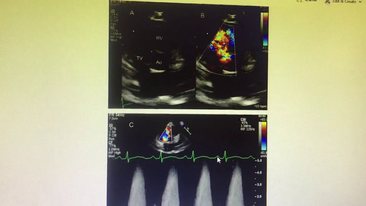 Gradient across VSD - YouTube