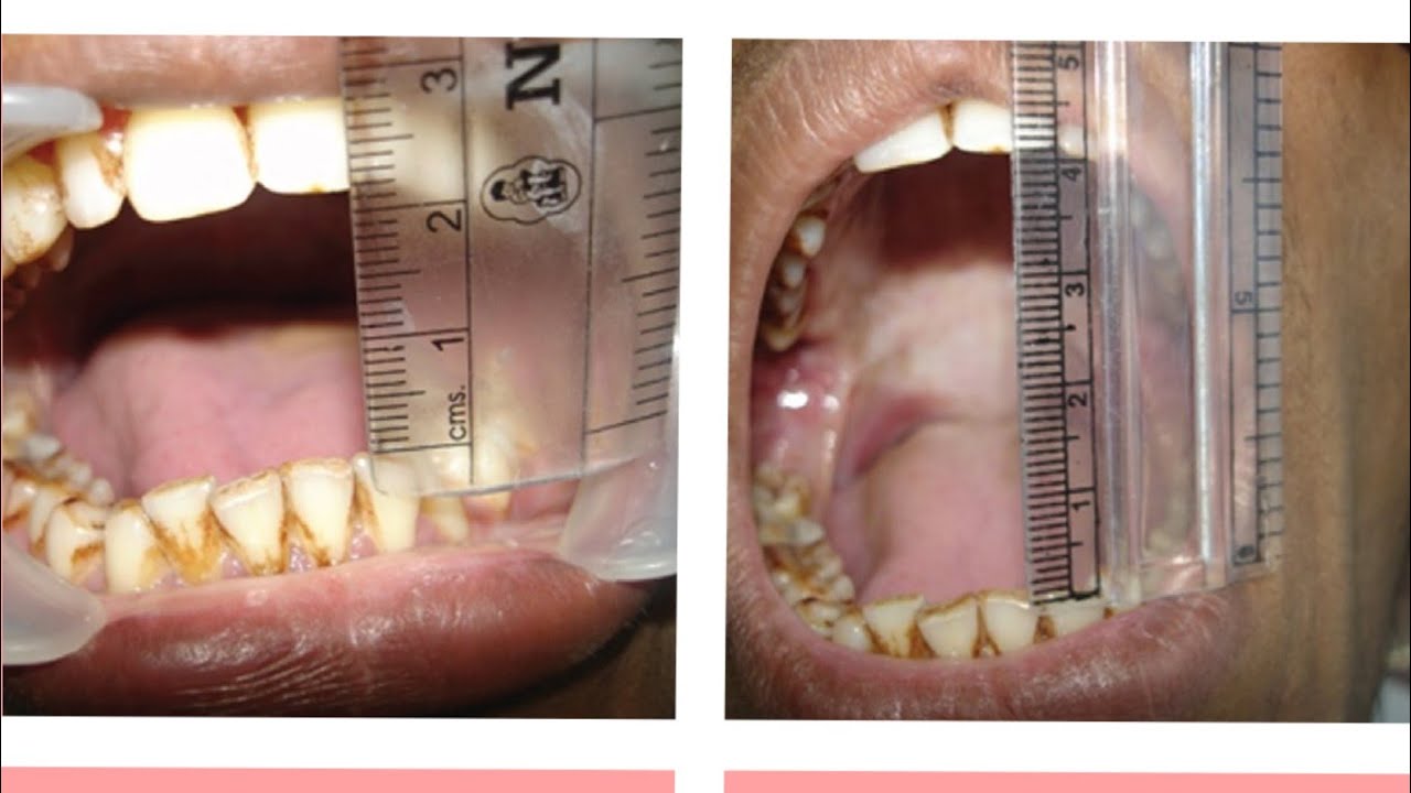 मूहँ का कम खुलना।REDUCED MOUTH OPENING-causes and treatment |#OSMF|Oral ...