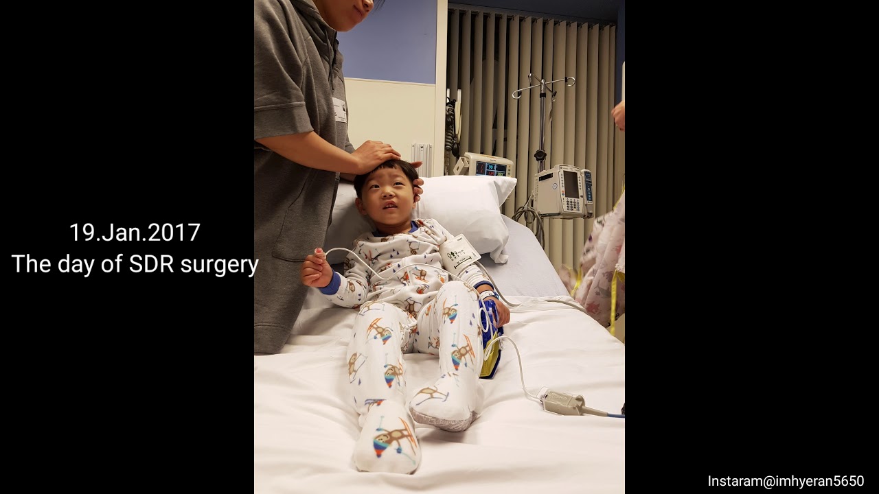 Pre/Post SDR ( selective dorsal rhizotomy ) surgery - YouTube