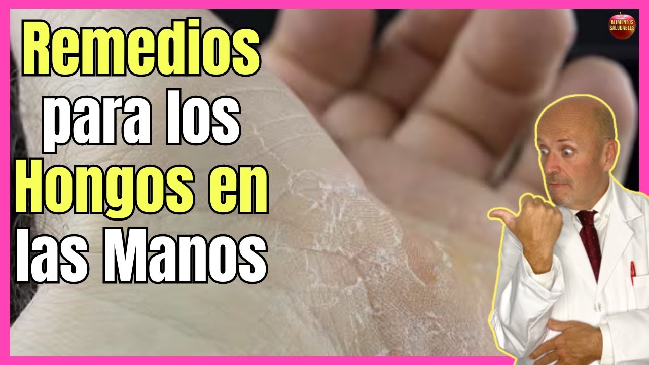 🔴 MEJORES REMEDIOS CASEROS PARA ELIMINAR LOS HONGOS EN LAS MANOS 🔴 ...