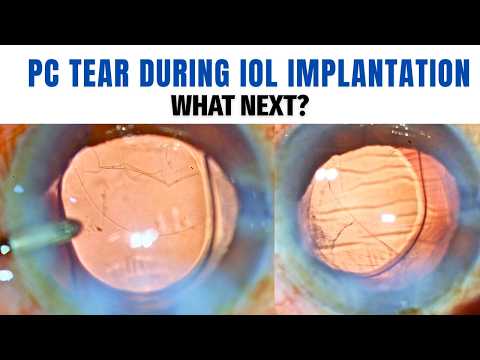 PC Tear during IOL implantation - complication management & My thought process : Dr. Deepak Megur