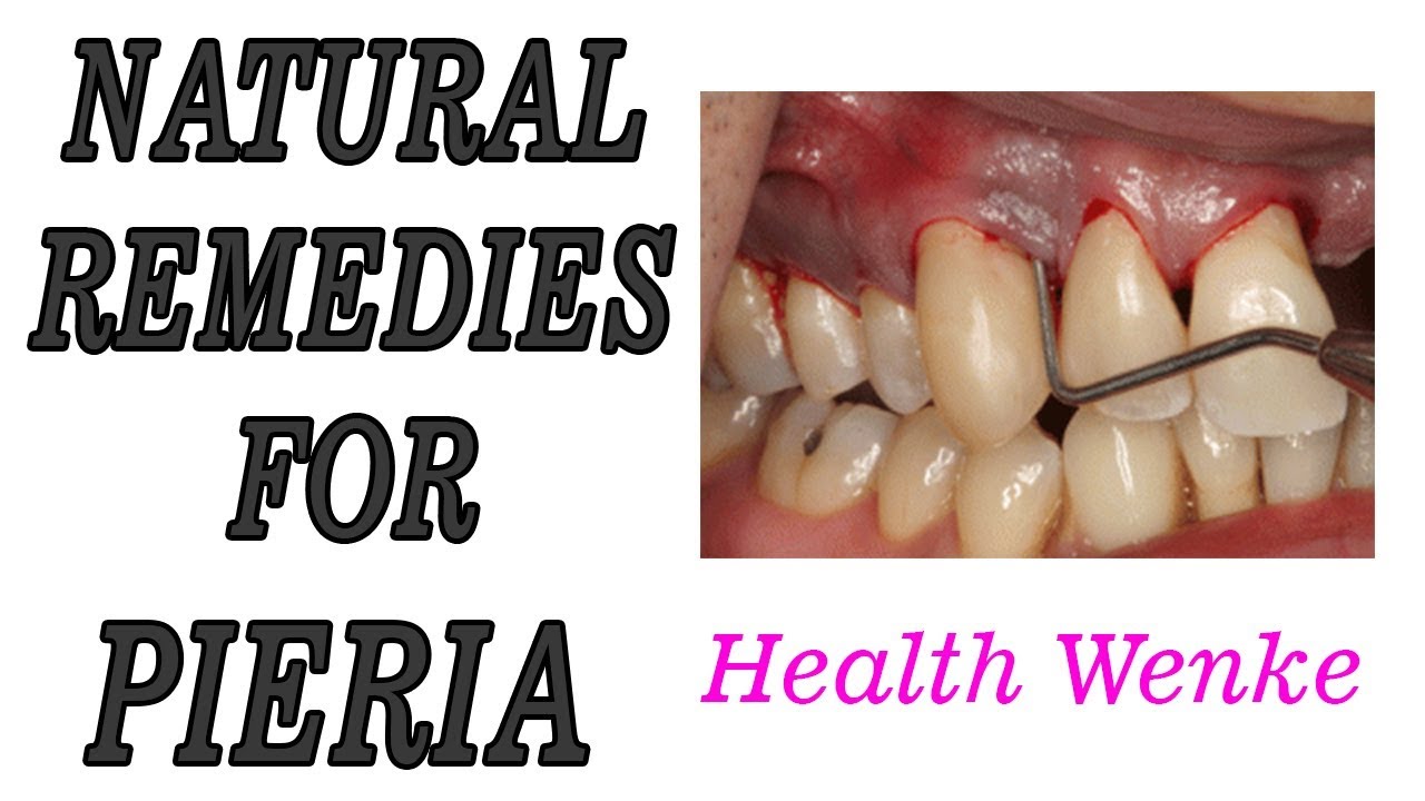 NATURAL REMEDIES FOR PIERIA | BEST NATURAL REMEDIES FOR PIERIA ...