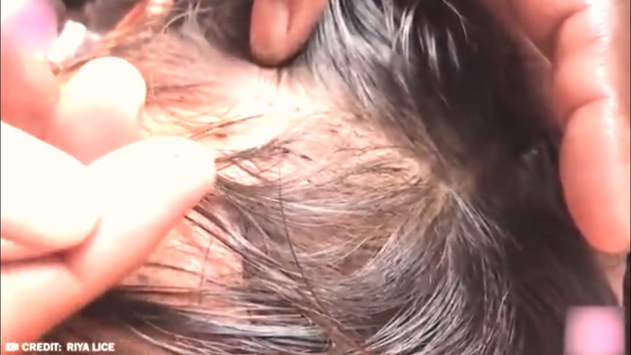 LICE Feeding on Human Blood || Dr.Vivek: Scientific - YouTube