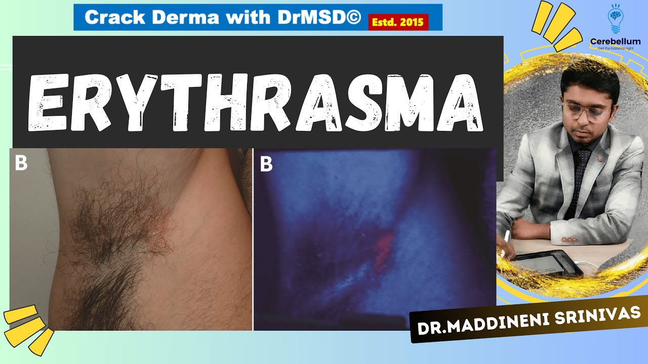 WOODS LAMP findings in ERYTHRASMA? Explained by a DERMATOLOGIST - YouTube