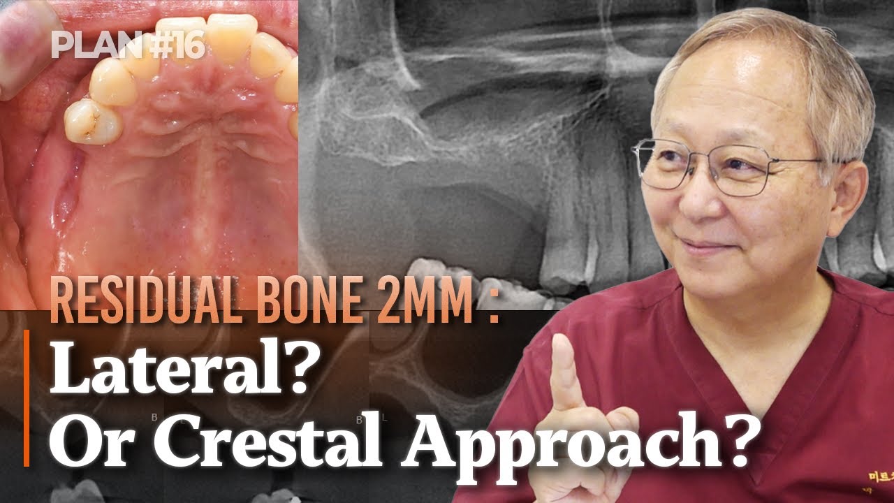 [Preview] Residual Bone 2mm Sinus Grafting Case - Crestal Approach ...