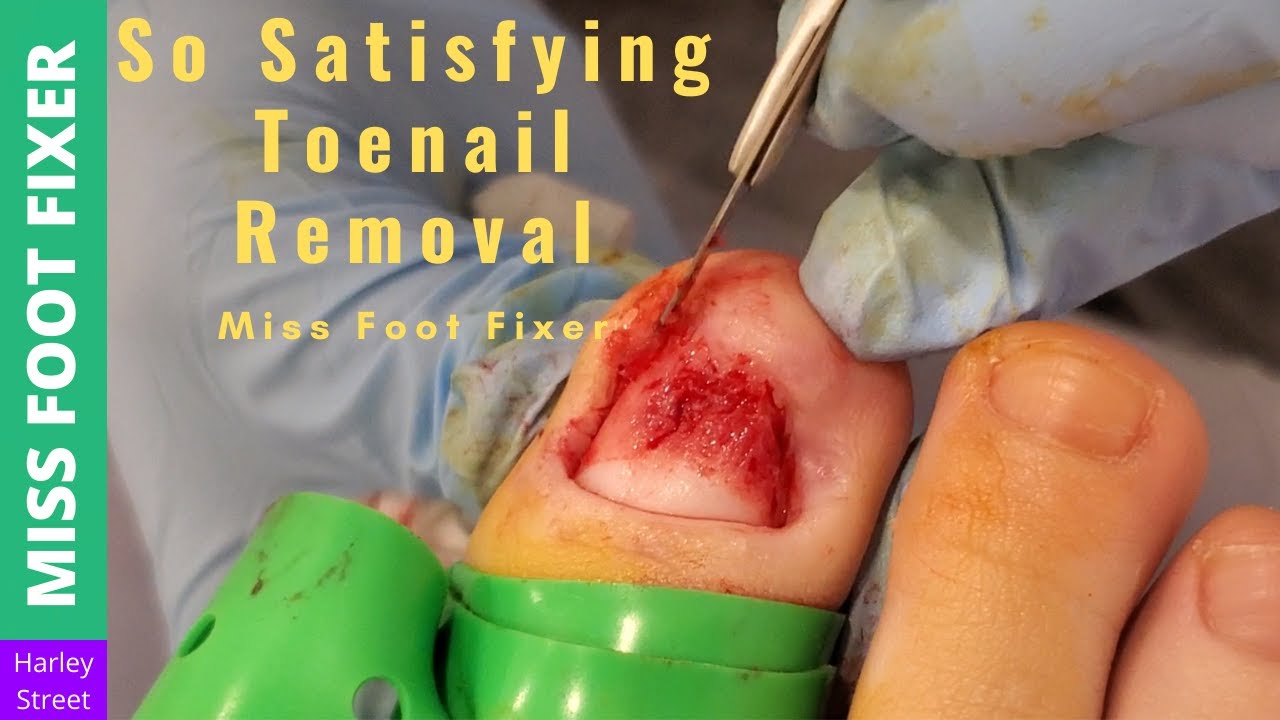 So Satisfying Toenail Removal | Miss Foot Fixer Marion Yau - YouTube