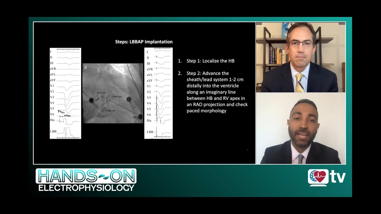 Hands-On Electrophysiology: Left Bundle Branch Pacing - YouTube