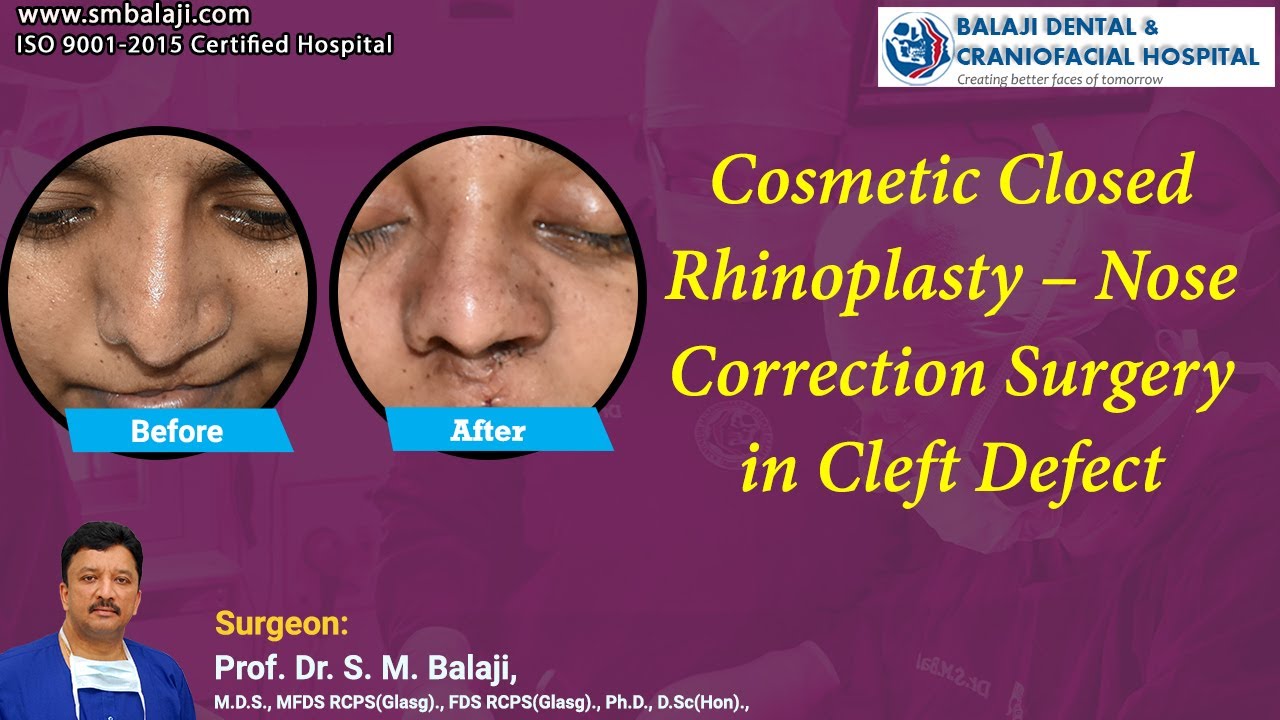 Cosmetic Closed Rhinoplasty – Nose Correction Surgery in Cleft Defect ...