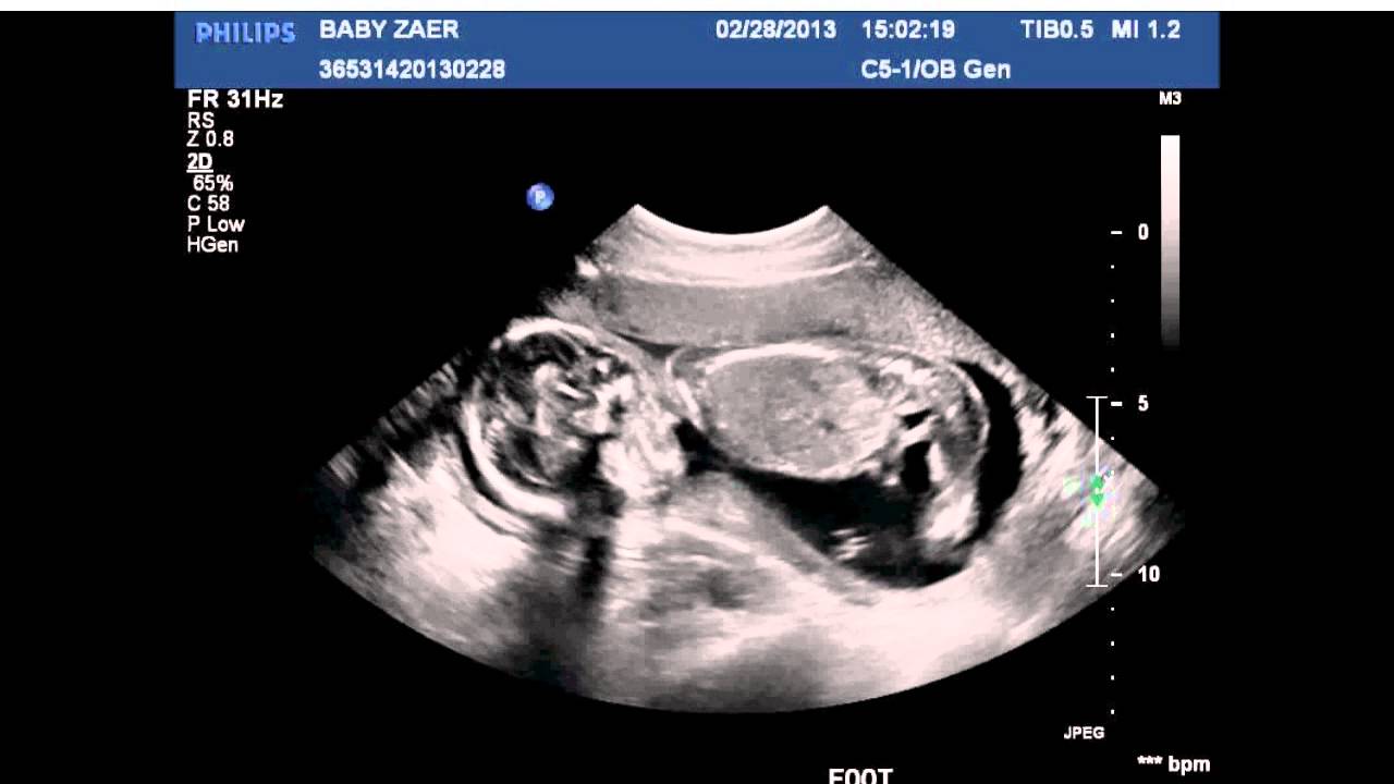 Harlem Shake Fetus - YouTube