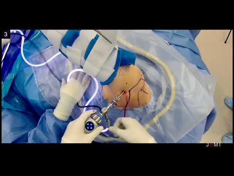 Arthroscopic Bankart Repair for Anterior Shoulder Instability Using a ...