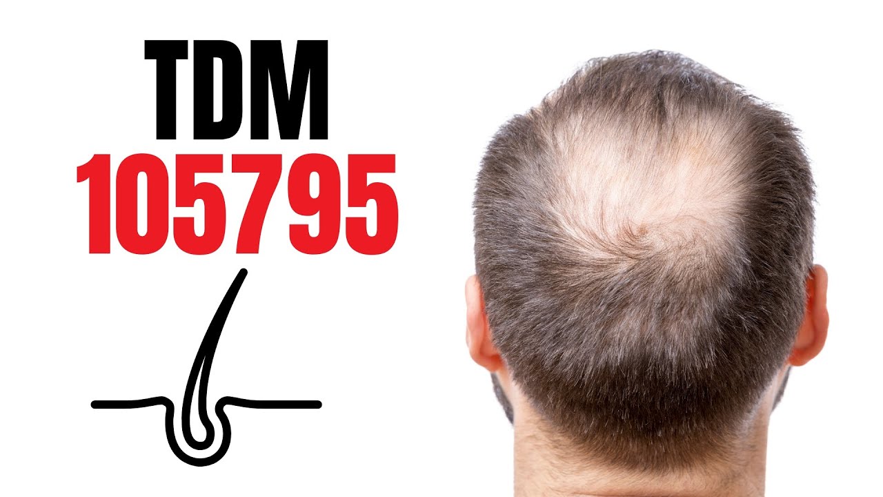 New Treatment That Can Regrow Your Hair! TDM 105795 - YouTube