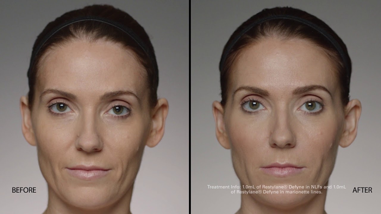 Restylane Defyne Before & After - YouTube