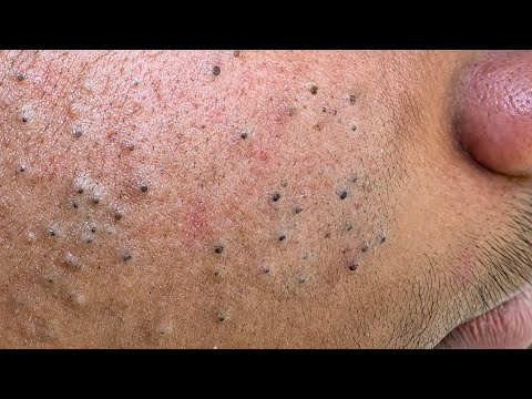 Extreme Close-Up 4K ASMR Pore Vacuum | No Talking | Glass Skin Transformation