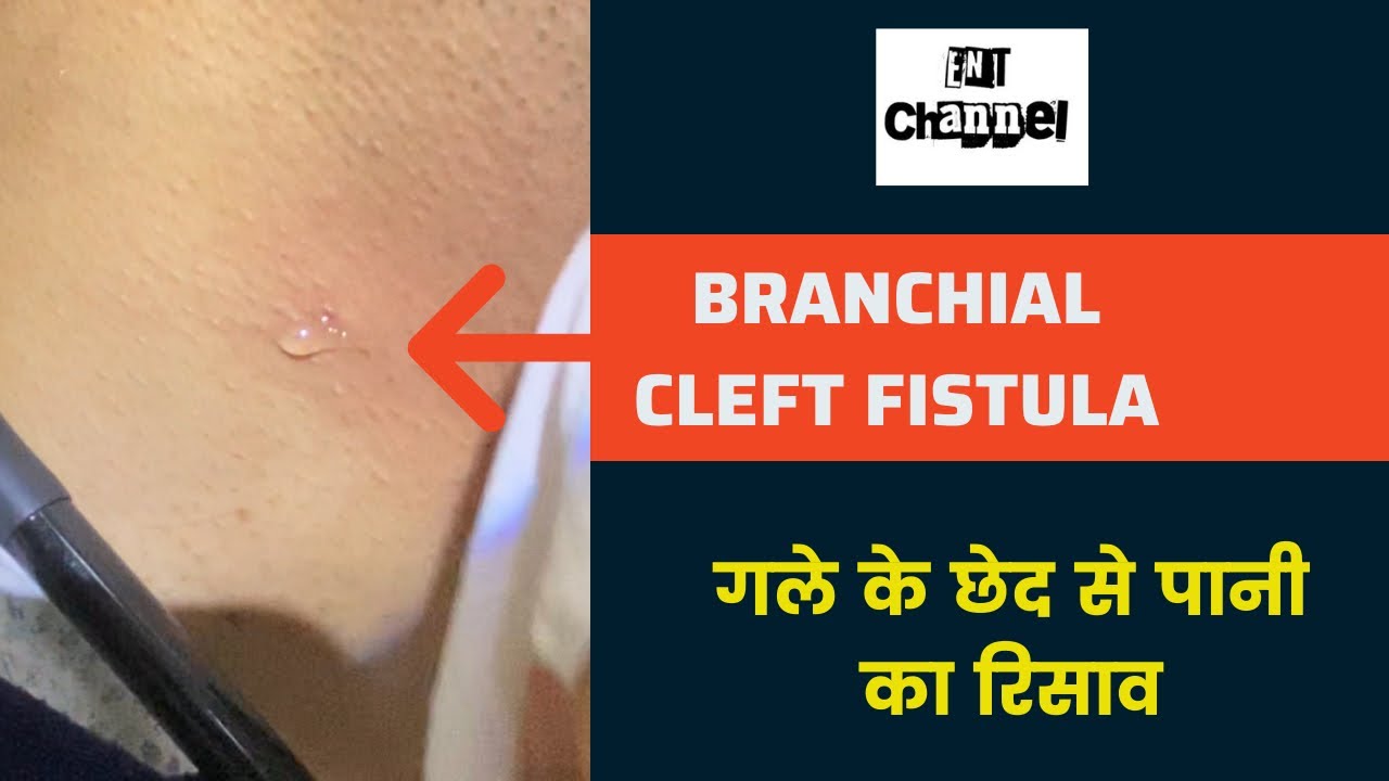 Branchial Cleft Sinus, Fistula and Cyst. गले में होने वाली सिस्ट या ...