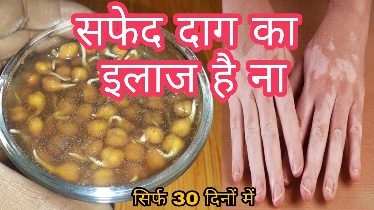 सफेद दाग को गायब कीजिए सिर्फ 30 दिनों में || Safed Daag ka Ilaj || Home ...