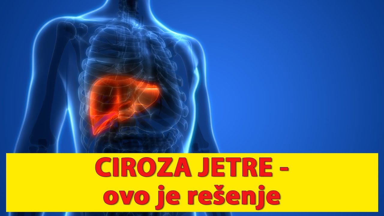 CIROZA JETRE - ovo je rešenje - Tema 377 - YouTube