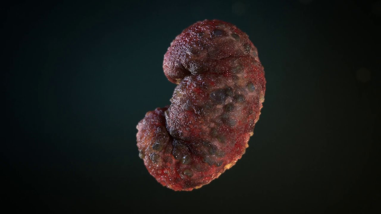 Kidney Disease Time Lapse Animation - YouTube