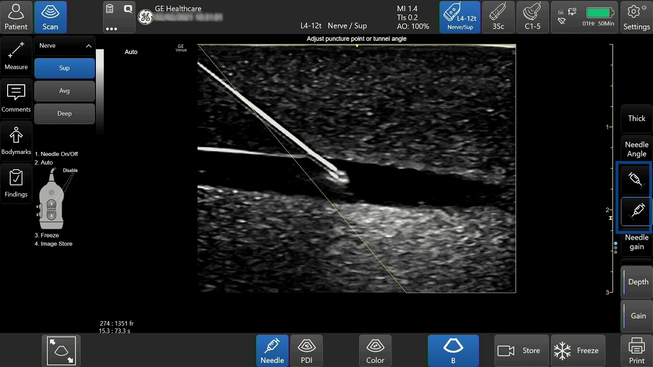 Venue™ Family R3 Tutorial - Needle Visualization - YouTube