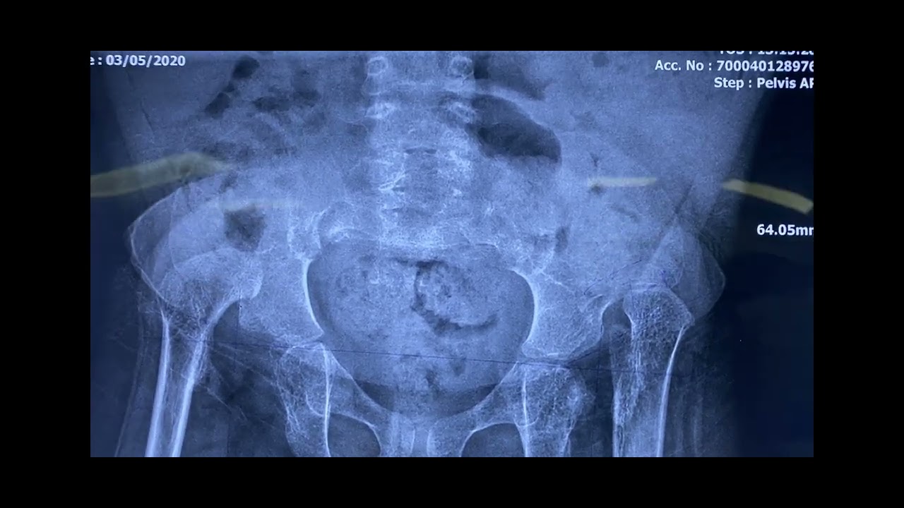 Congenital Knee Dislocation Recurvatum Deformity (CKD/CDK) Surgery in 3 ...