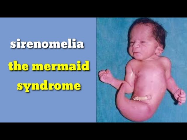 Sirenomelia Milagros Cerron