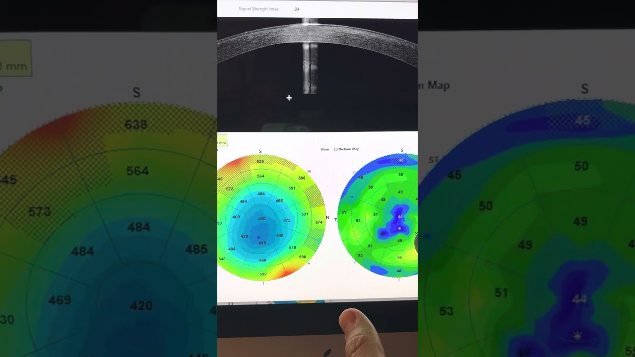 6months after PRK and CXL for keratoconus: studying a case performed ...