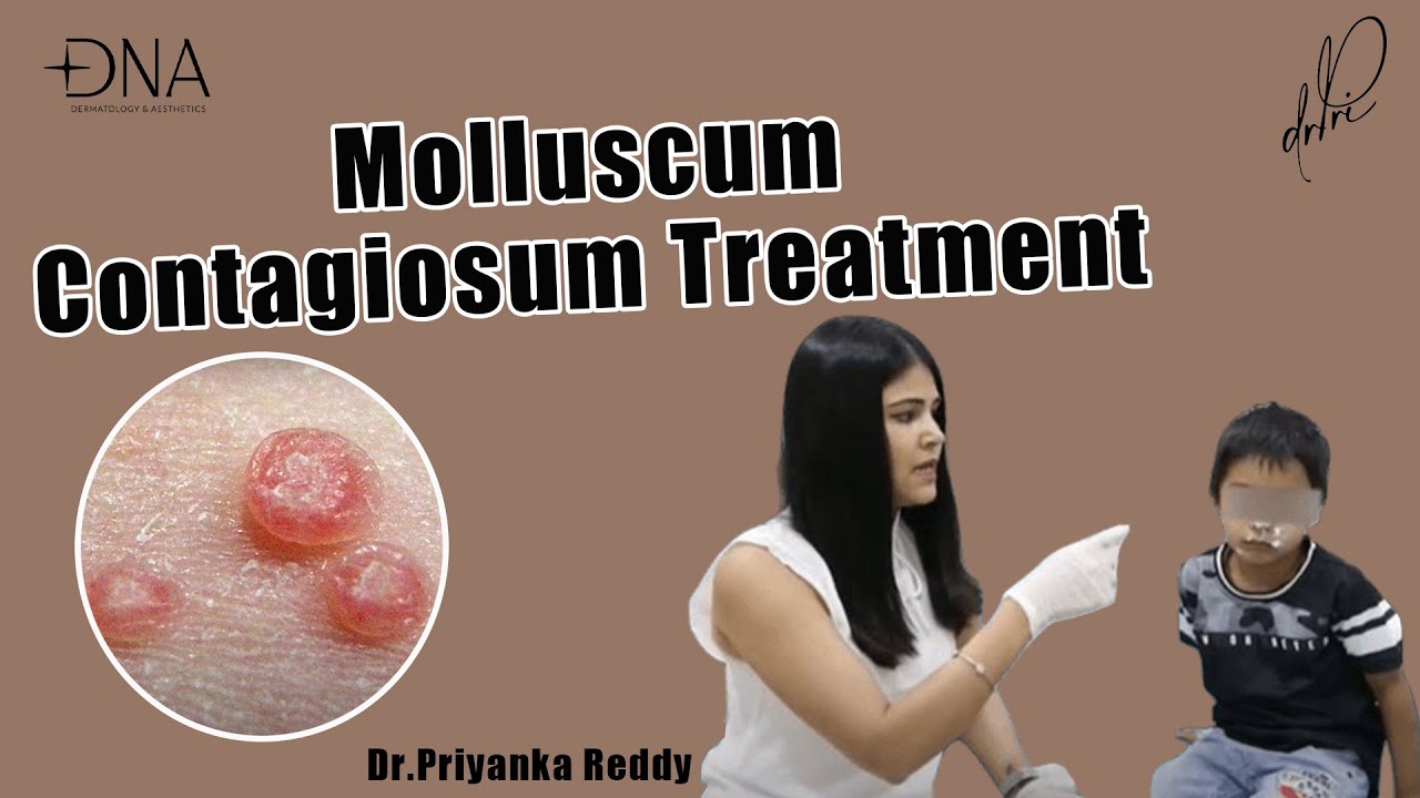 How to treat Molluscum Contagiosum? | Treatment of viral skin infection ...